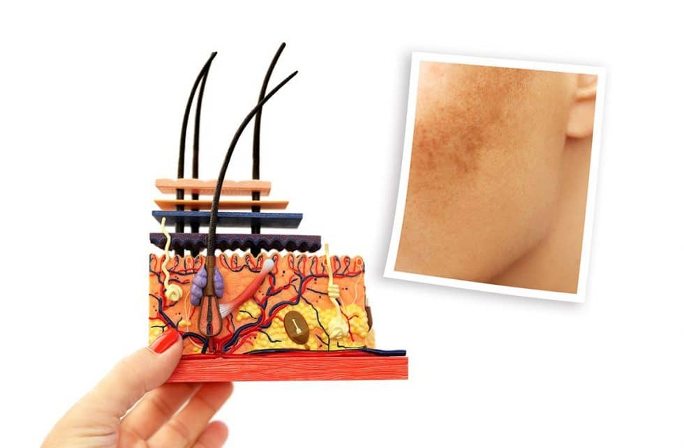 Избелващ пилинг Amelan | МЦ ДЕРМА ВИТА